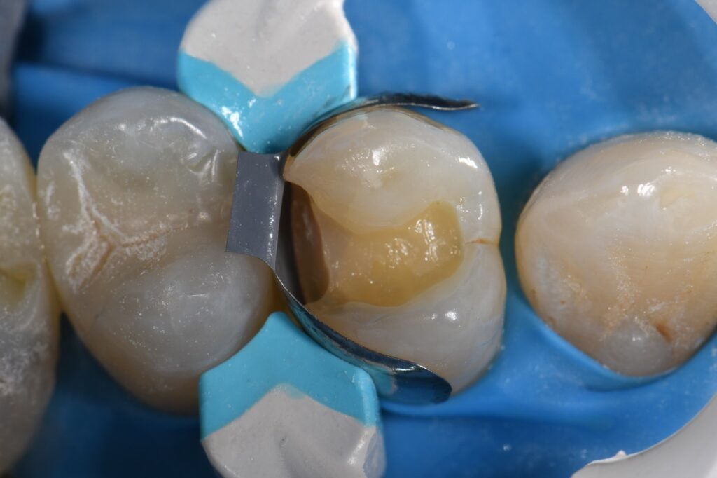 How to use the new Garrison Dental Solutions matrix to close large gaps