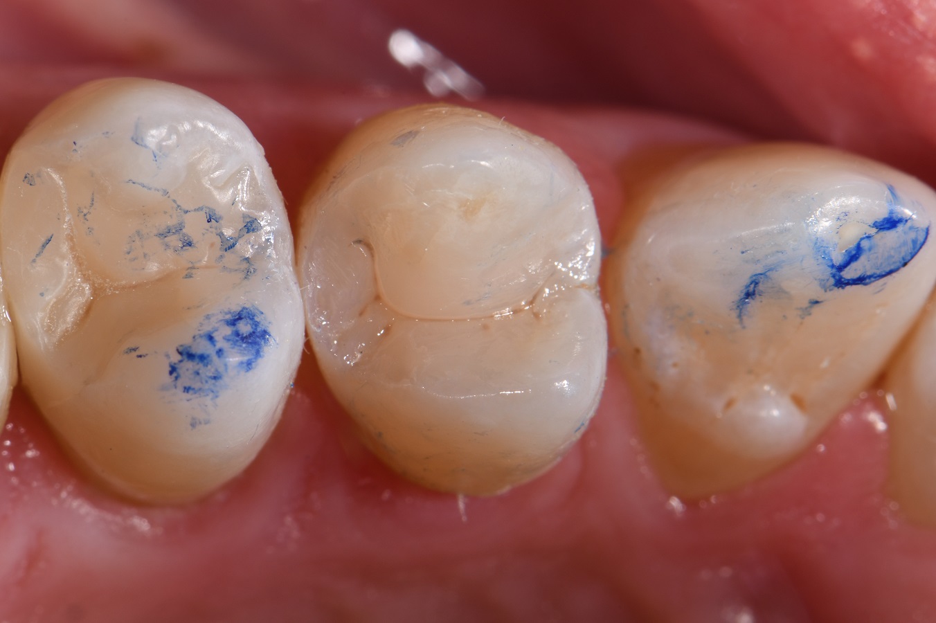 How to use the new Garrison Dental Solutions matrix to close large gaps