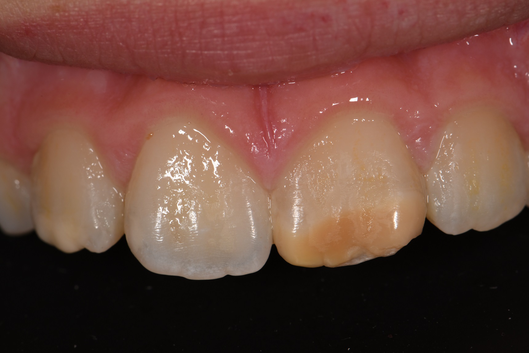 Layered Composite Veneer in the Esthetic Zone