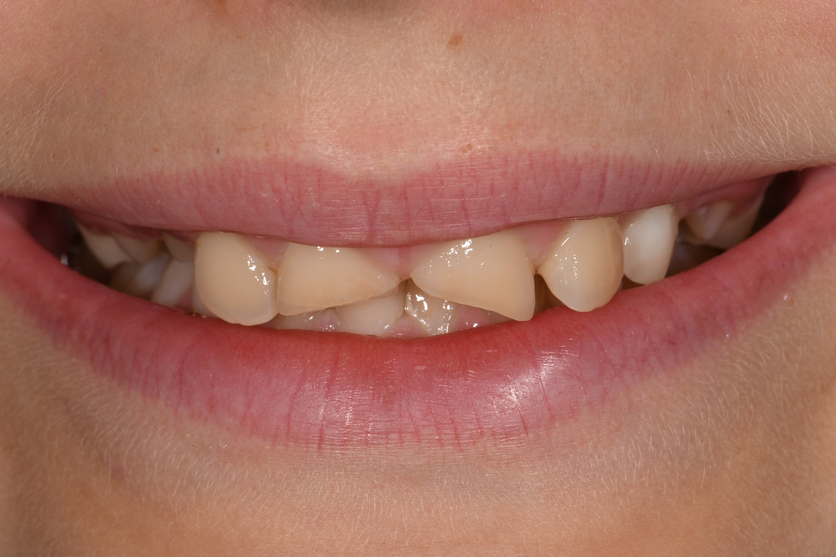 Restoring Fractures and restoring confidence with composite layering