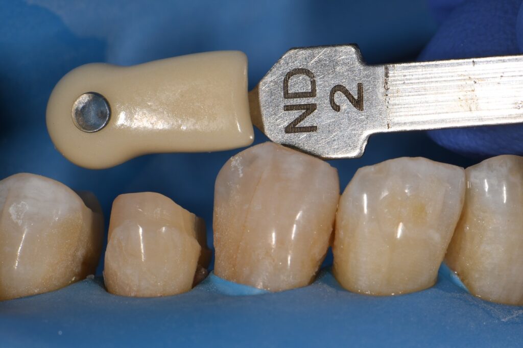 Porcelain Overlays that Blend into tooth structure