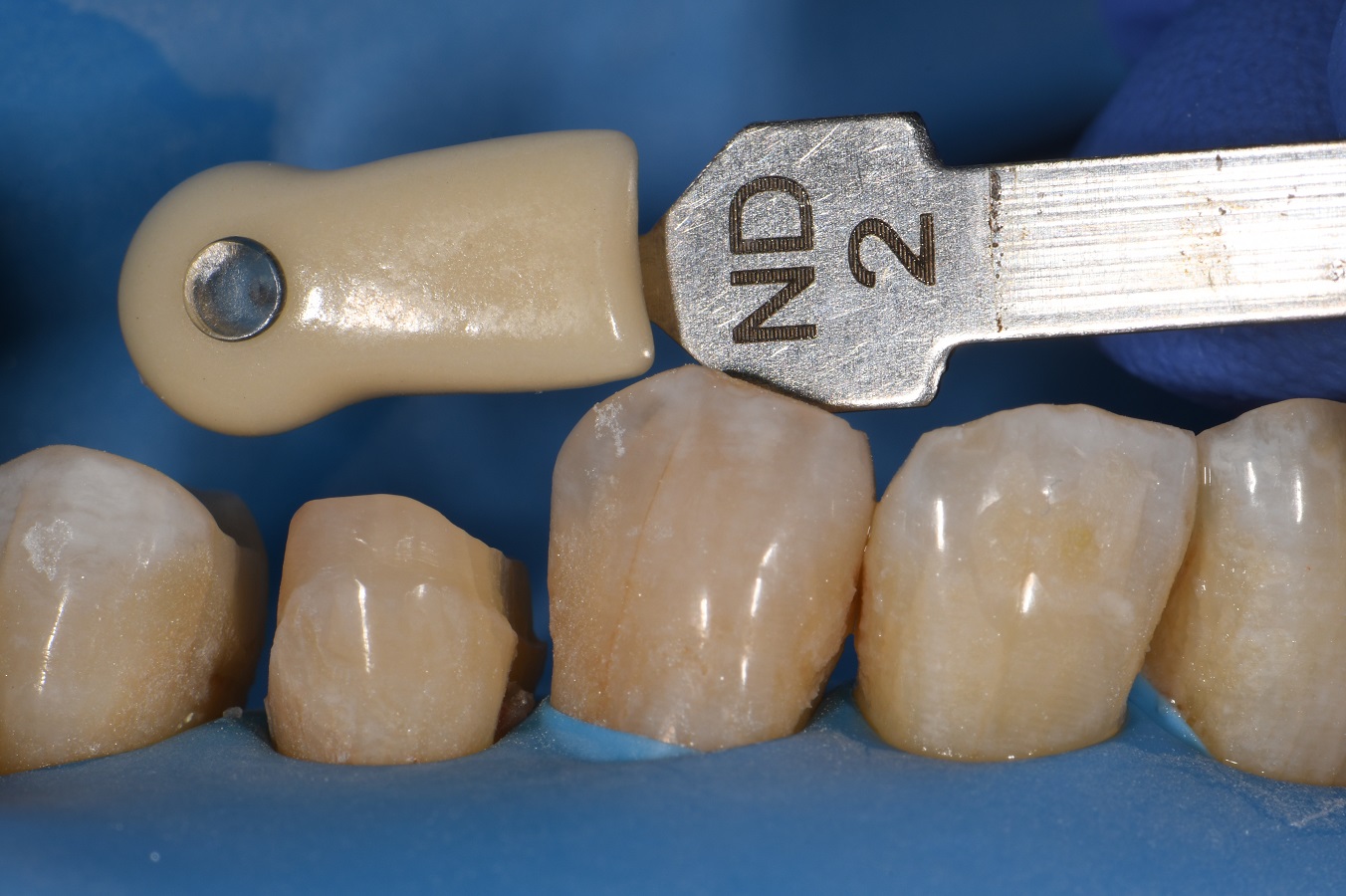 Porcelain Overlays that Blend into tooth structure