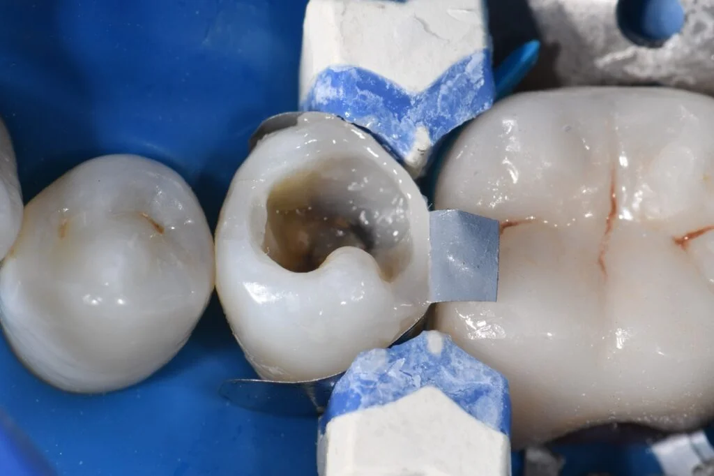 Reconstruction of an Extensively Broken down Bicuspid