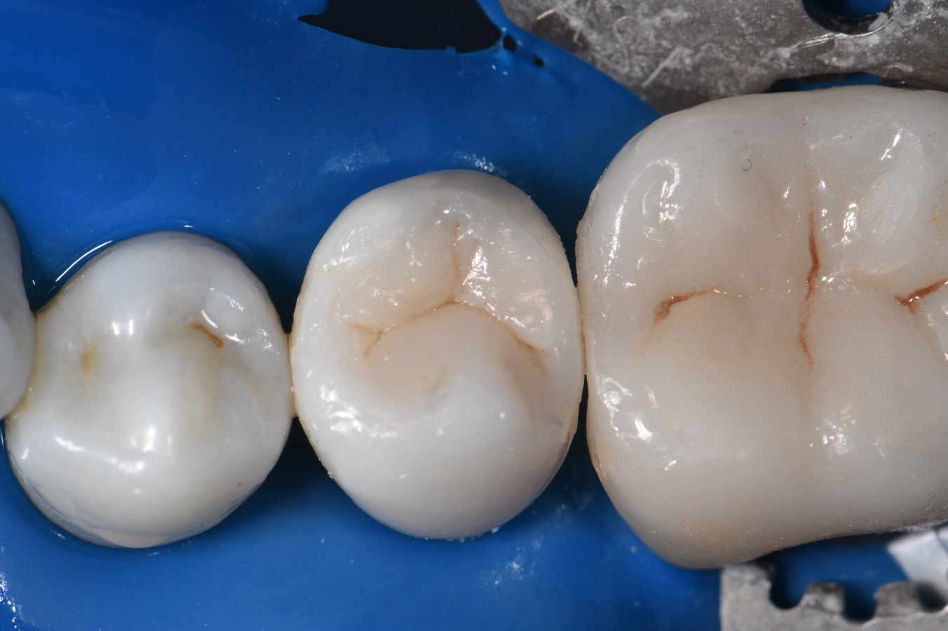Reconstruction of an Extensively Broken down Bicuspid