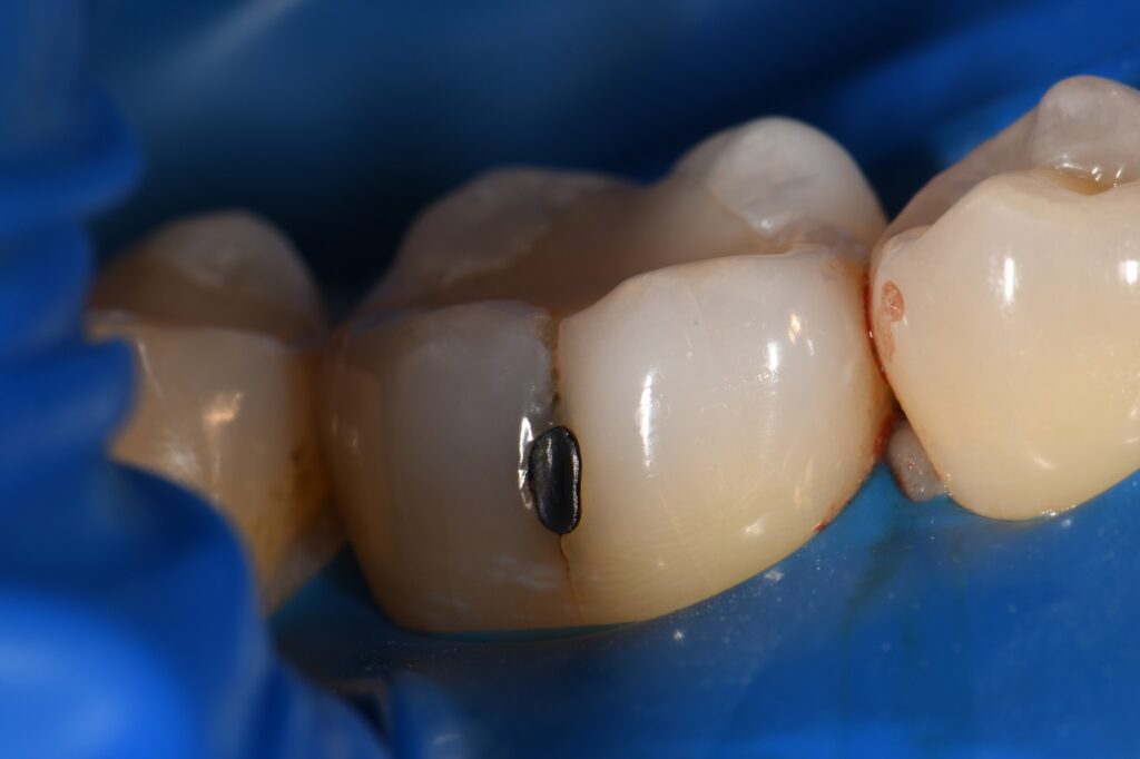 Amalgam replacement with Supercomposite restoration
