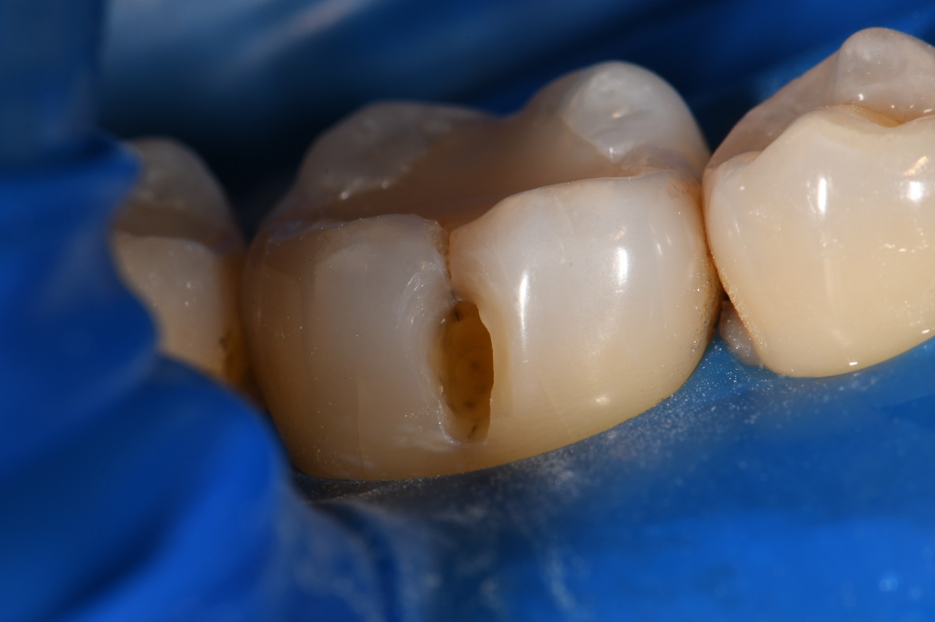 Amalgam replacement with Supercomposite restoration