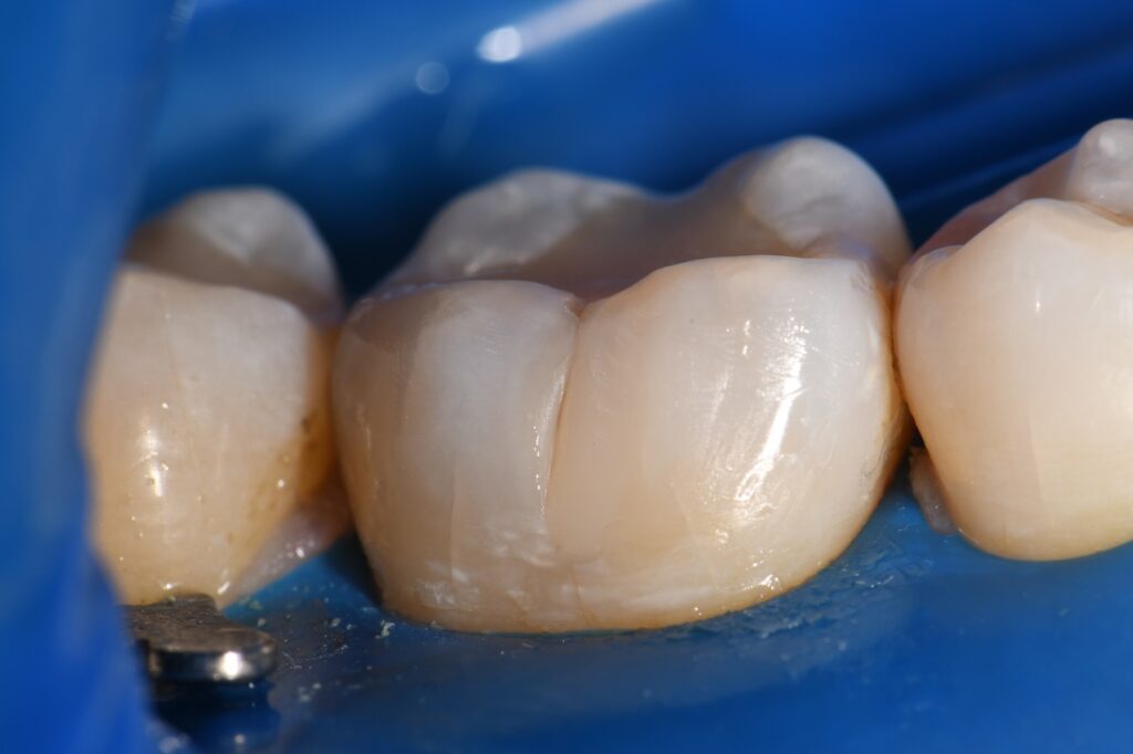 Amalgam replacement with Supercomposite restoration