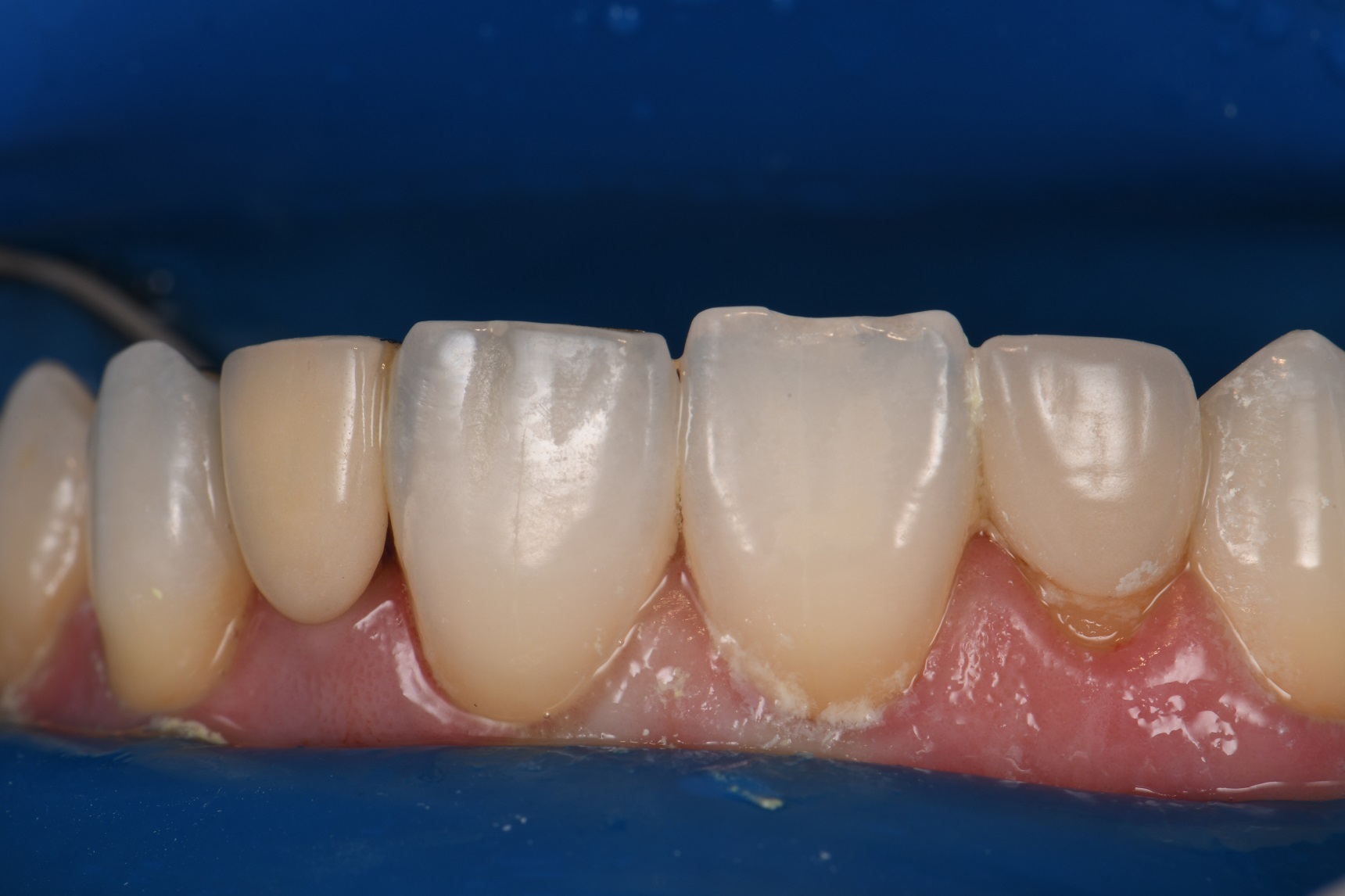 How to make a Maryland Bridge and Veneer Blend with Nature