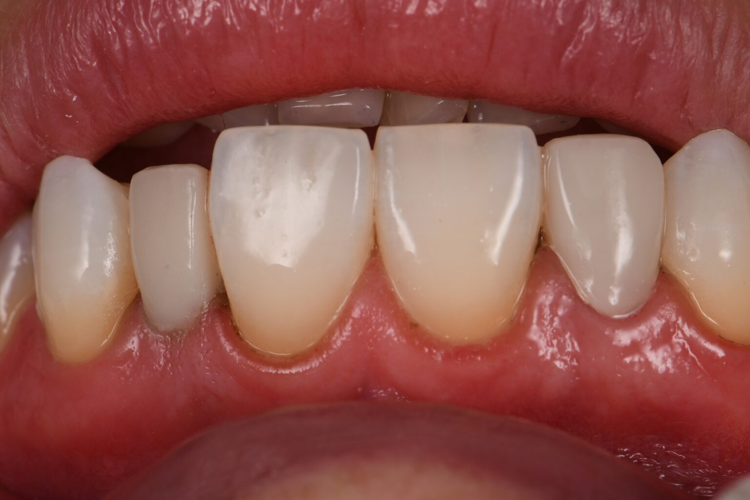 How to make a Maryland Bridge and Veneer Blend with Nature