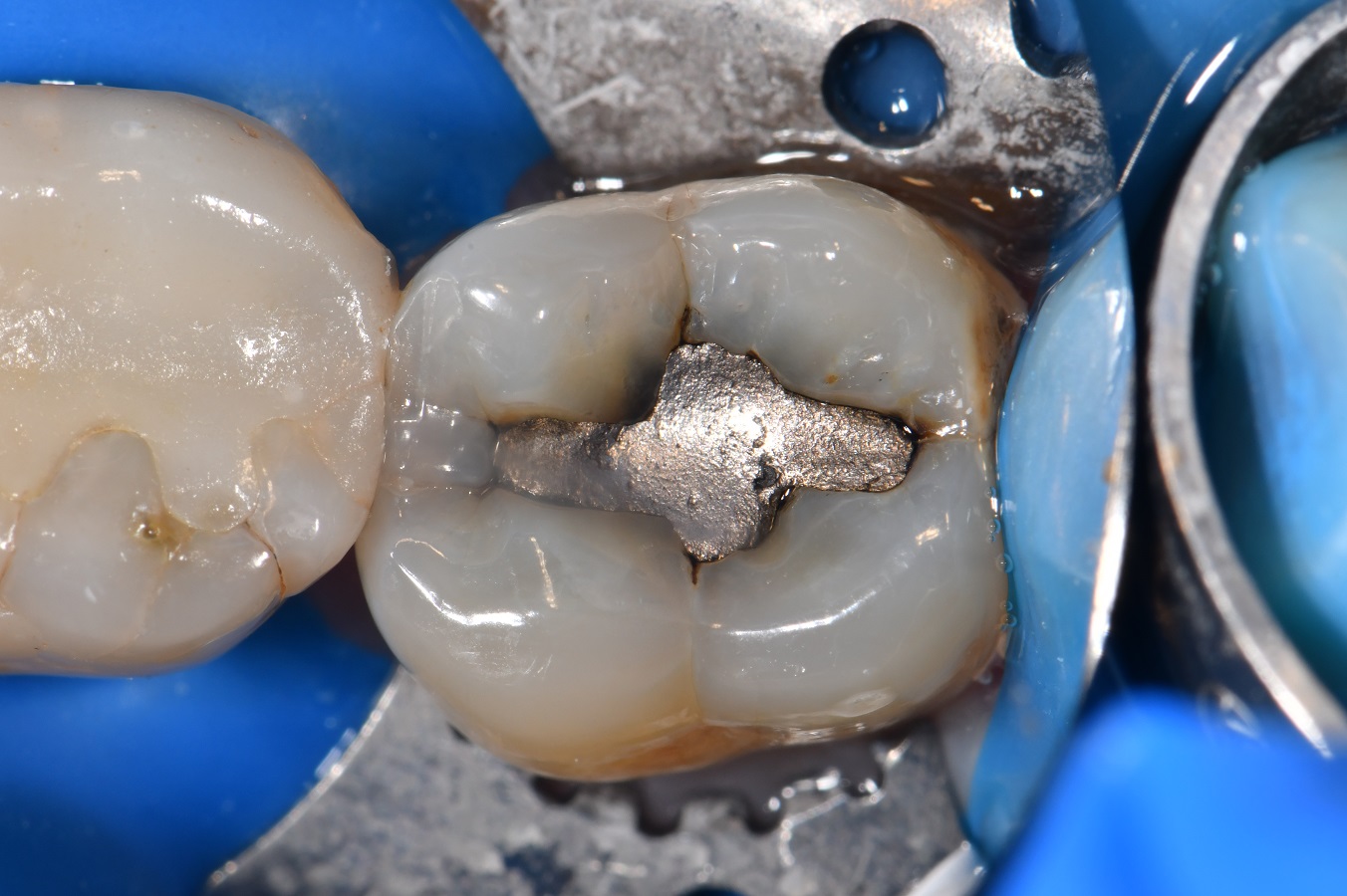 Restoring Amalgam-Filled Teeth and a Surprise Crack