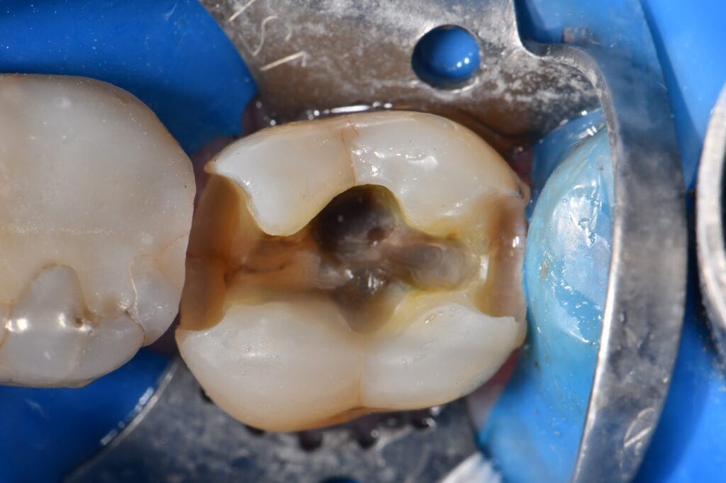 Restoring Amalgam-Filled Teeth and a Surprise Crack