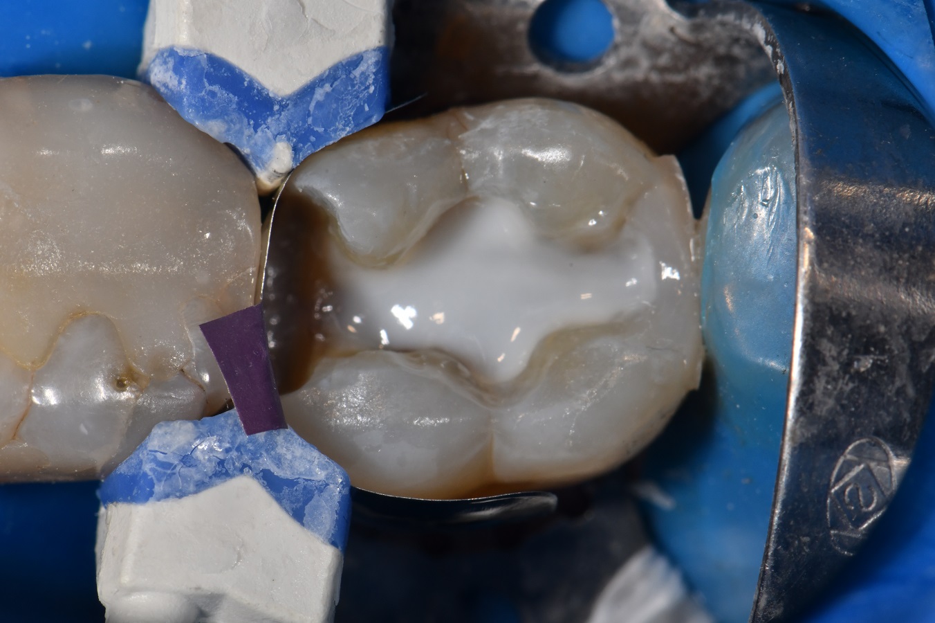 Restoring Amalgam-Filled Teeth and a Surprise Crack