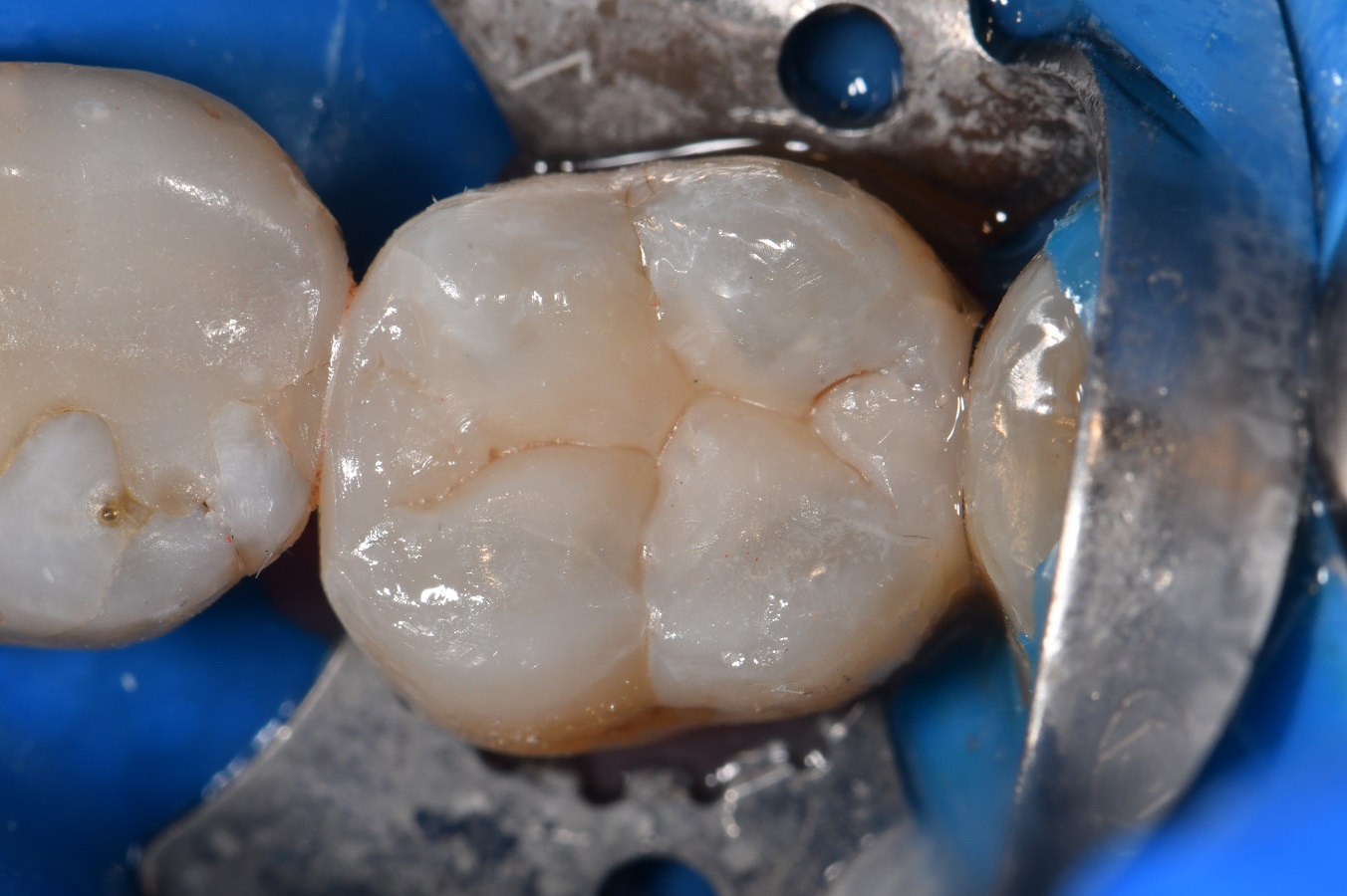 Restoring Amalgam-Filled Teeth and a Surprise Crack