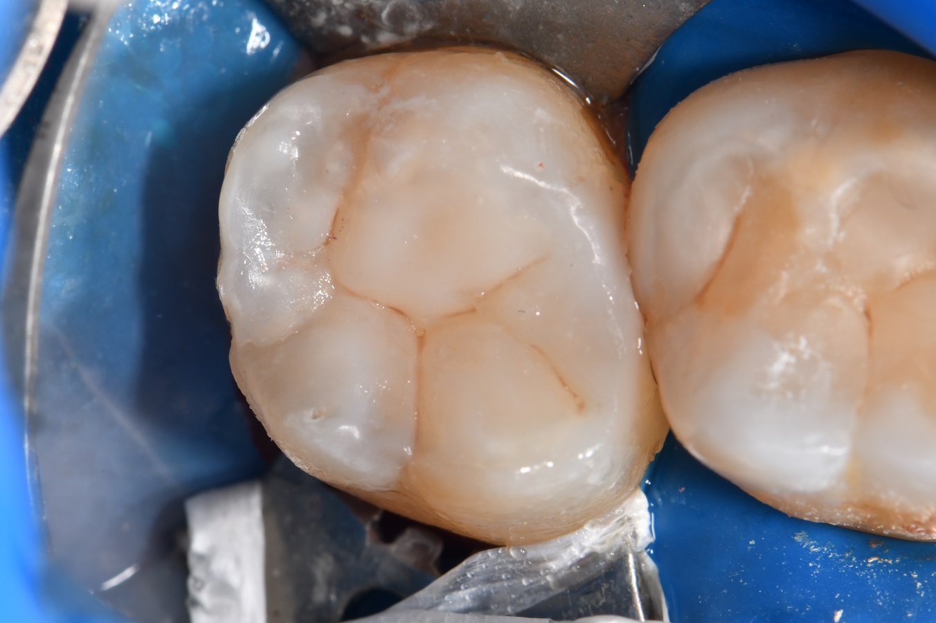 Kerr Simplishade in large Class II restoration