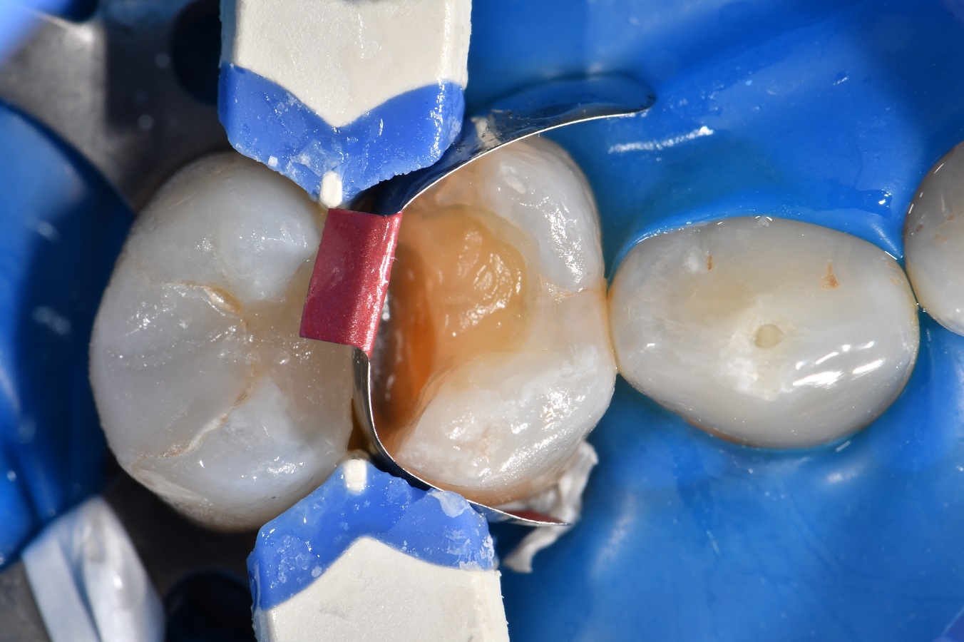 Rebuilding a mesially drifted bicuspid with composite