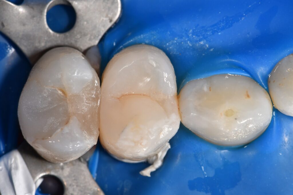 Rebuilding a mesially drifted bicuspid with composite