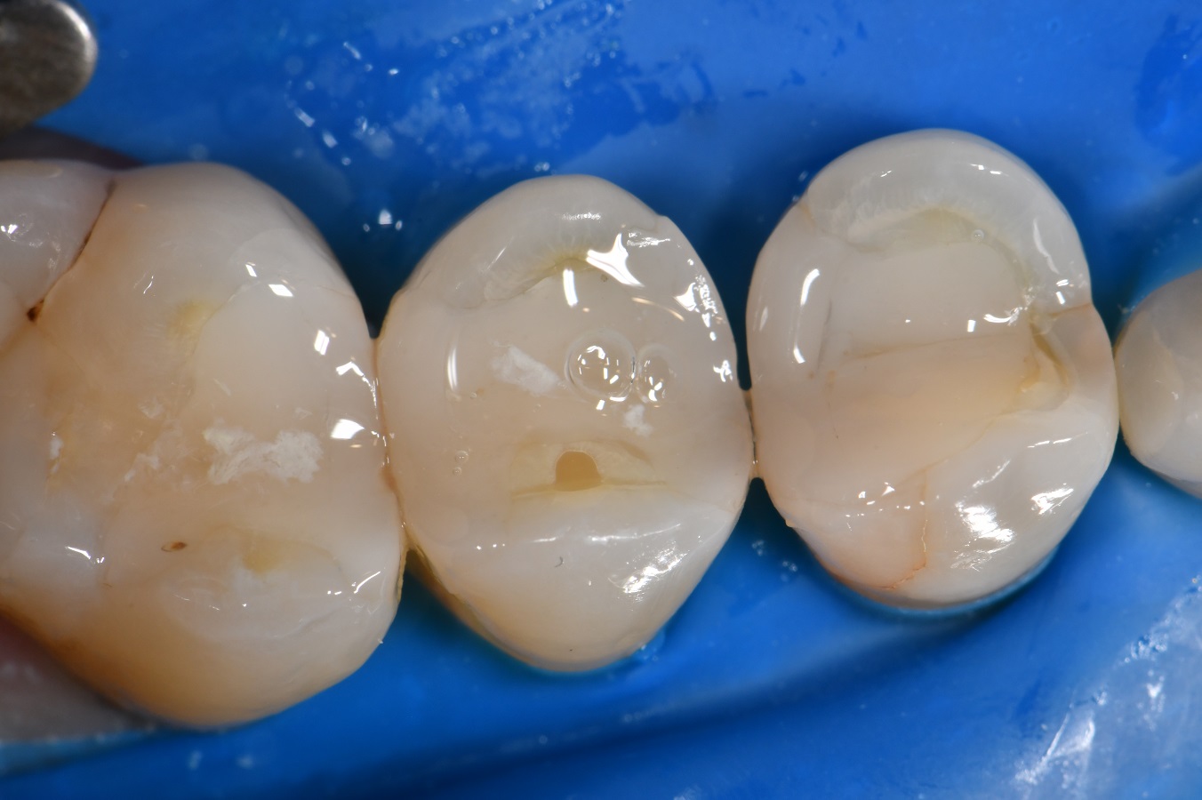 How to use Garrison Strata-G sectional matrix