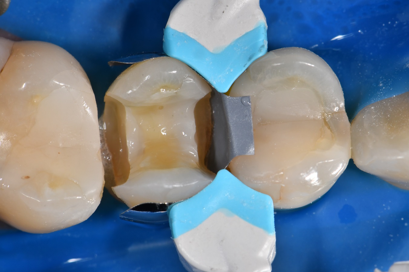 How to use Garrison Strata-G sectional matrix