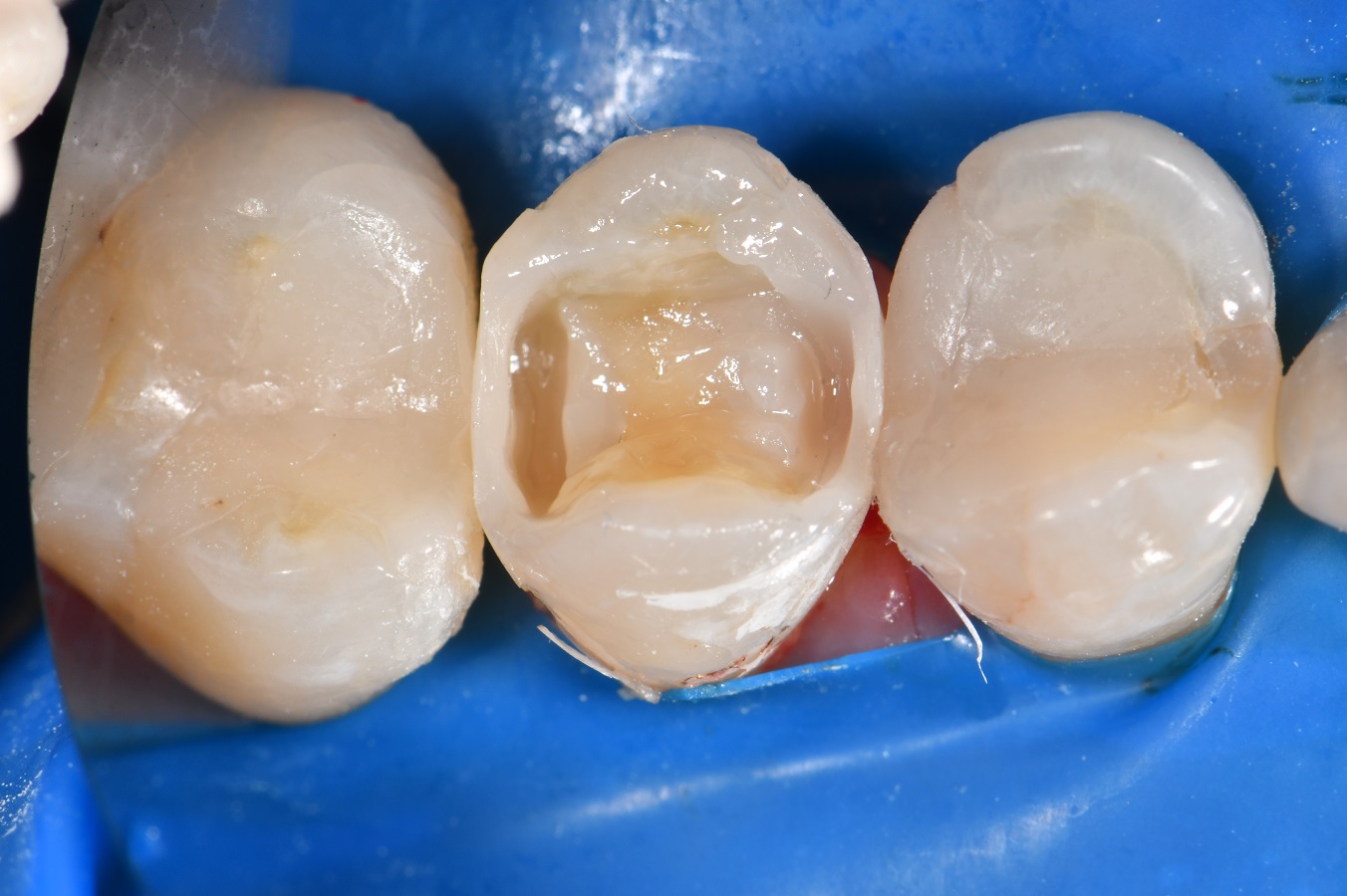 How to use Garrison Strata-G sectional matrix