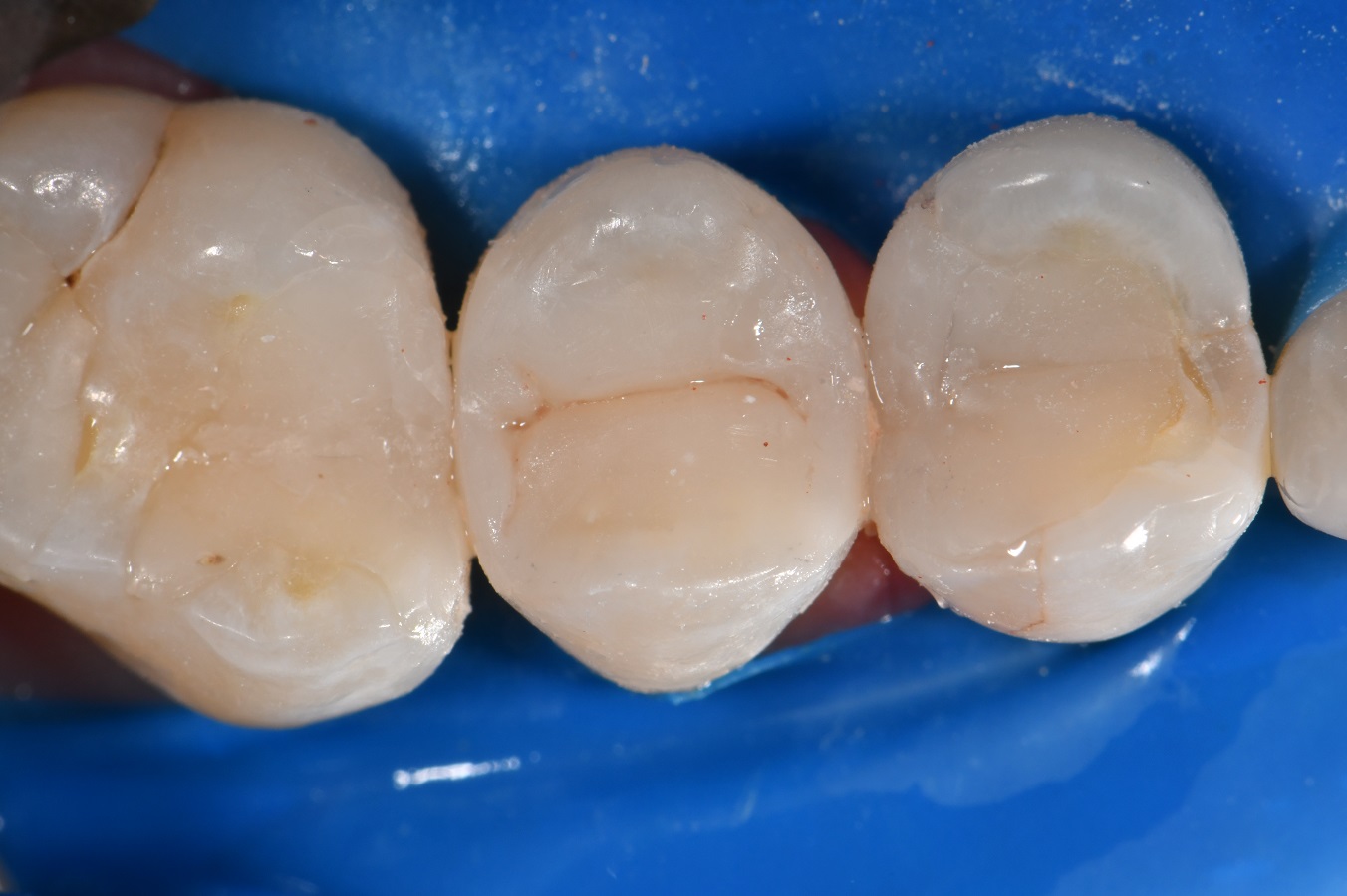 How to use Garrison Strata-G sectional matrix