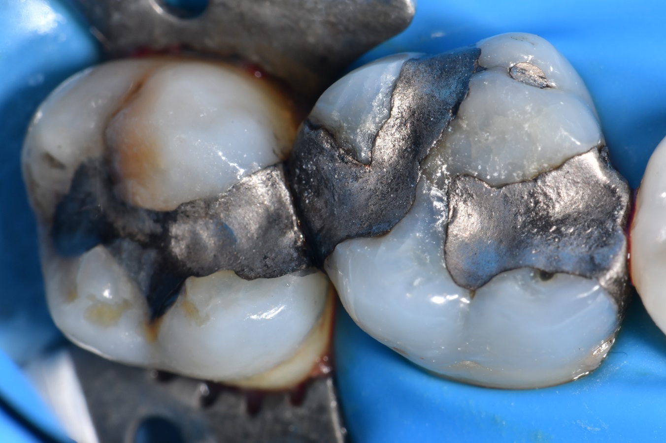 Matrix in a Matrix approach to rebuilding a free end Class II situation