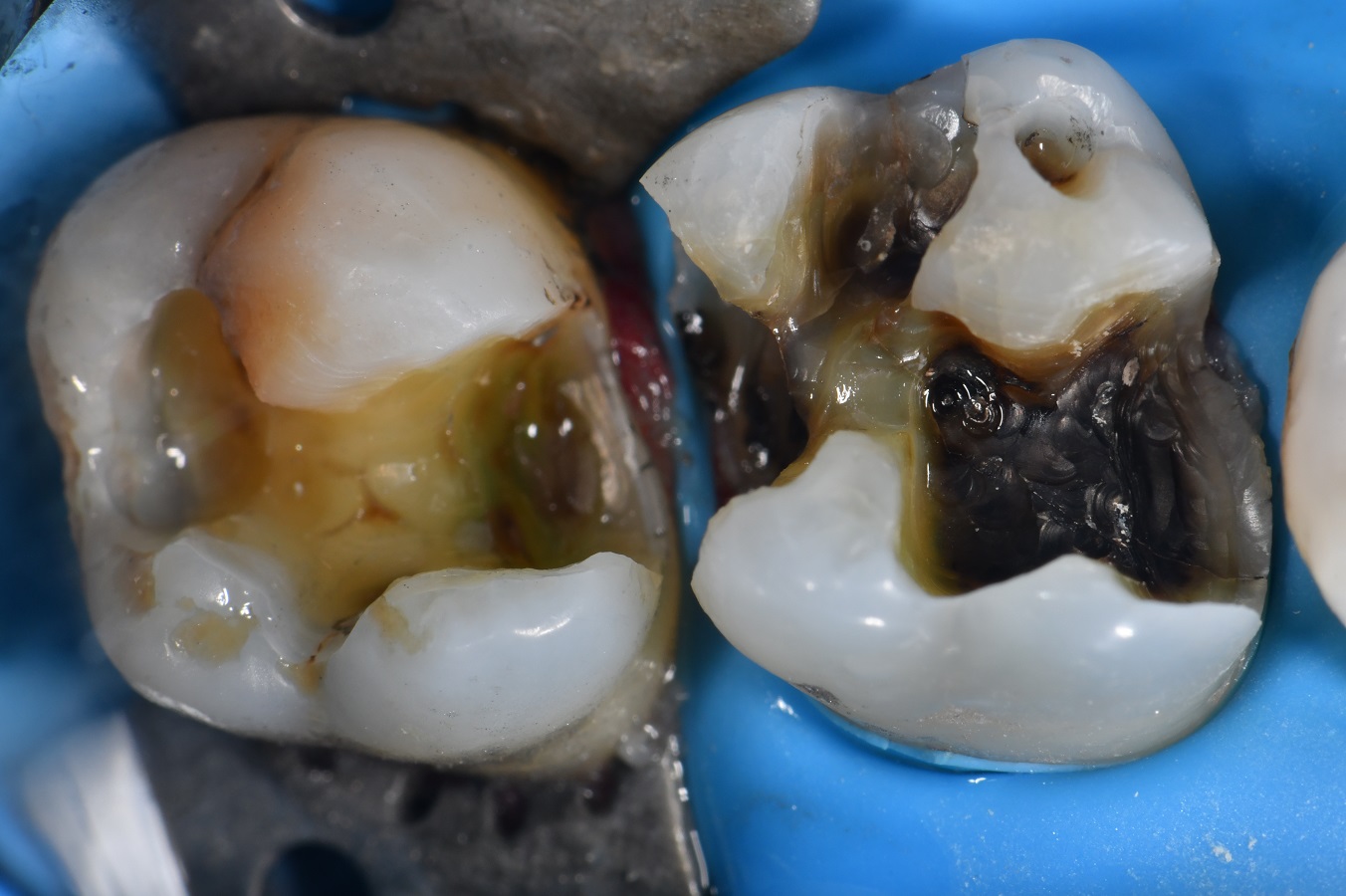 Matrix in a Matrix approach to rebuilding a free end Class II situation