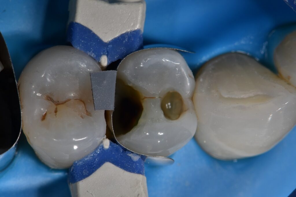 Voco Grandio SO in a complex composite restoration