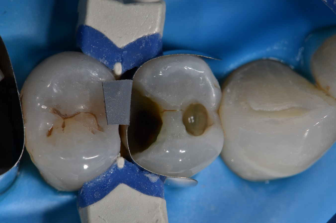 Voco Grandio SO in a complex composite restoration