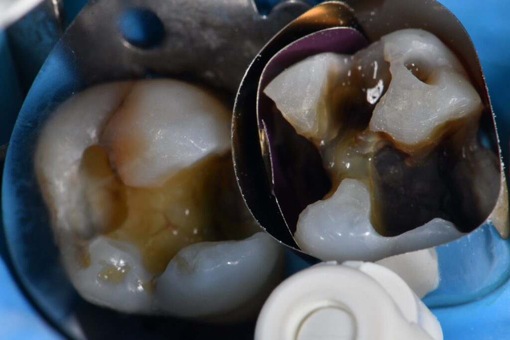 Matrix in a Matrix approach to rebuilding a free end Class II situation