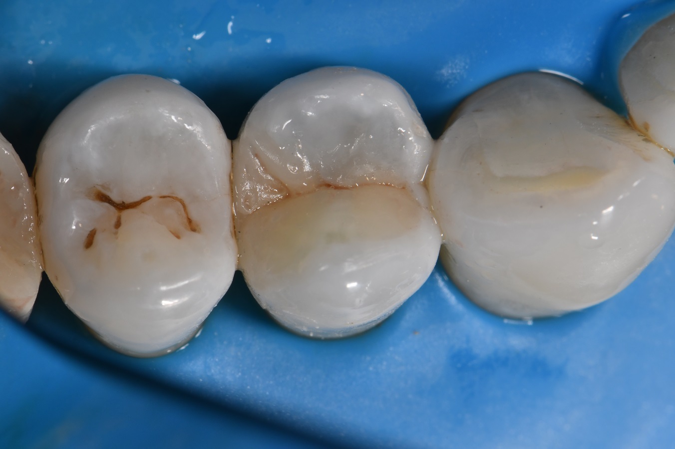 Voco Grandio SO in a complex composite restoration