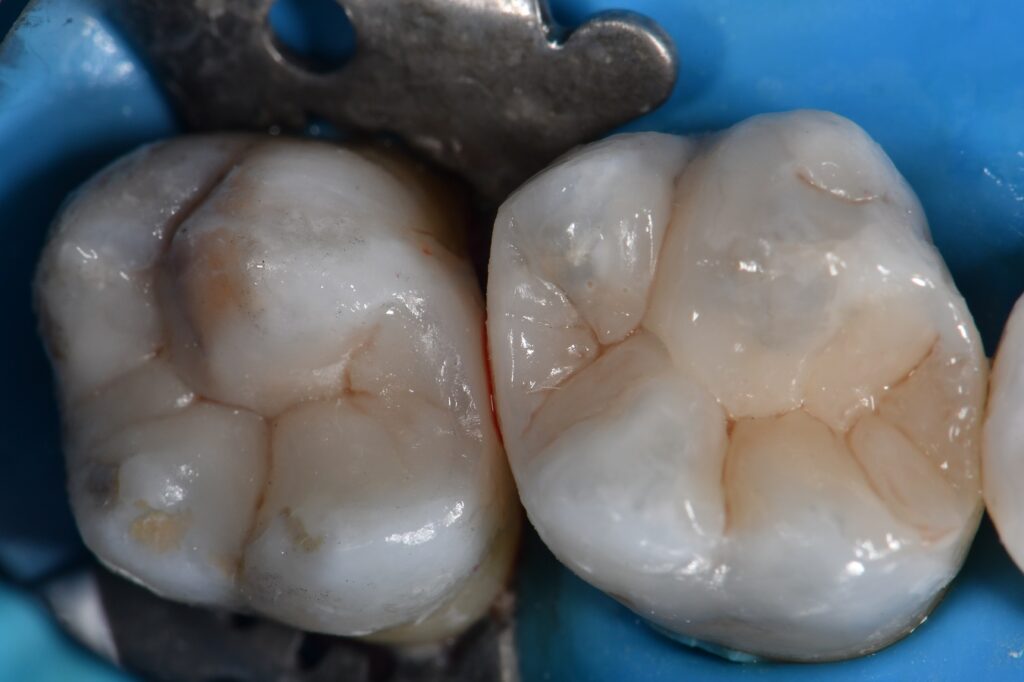 Matrix in a Matrix approach to rebuilding a free end Class II situation