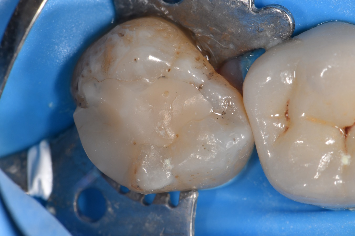 Composite Class II restoration replacement