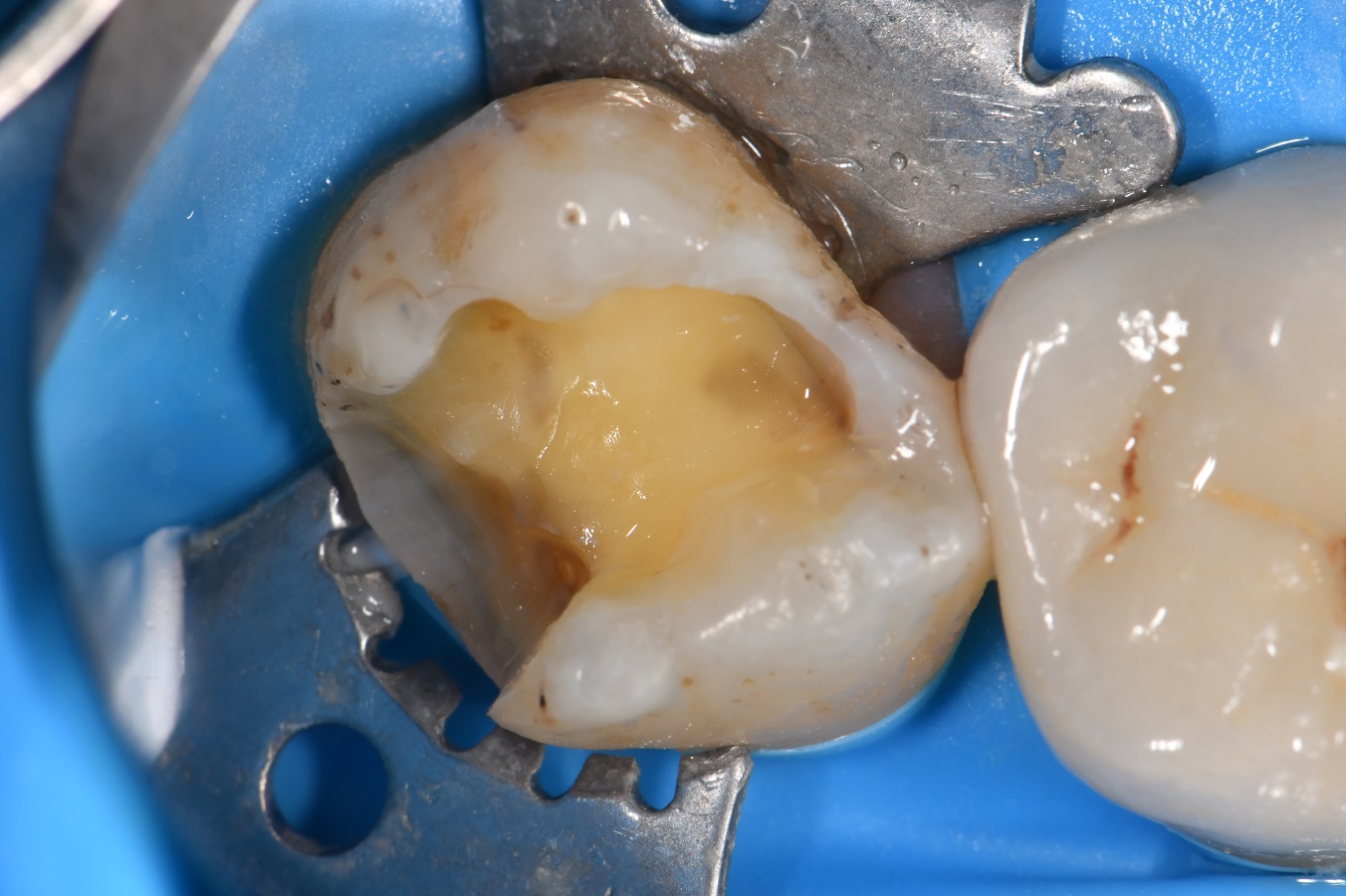 Composite Class II restoration replacement