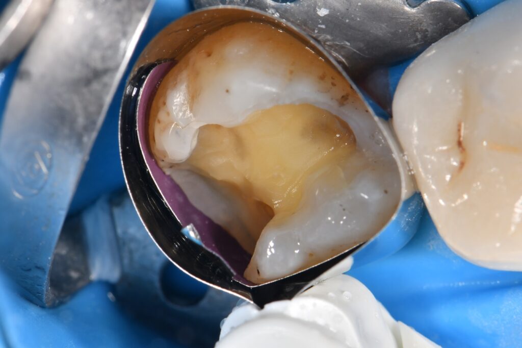 Composite Class II restoration replacement