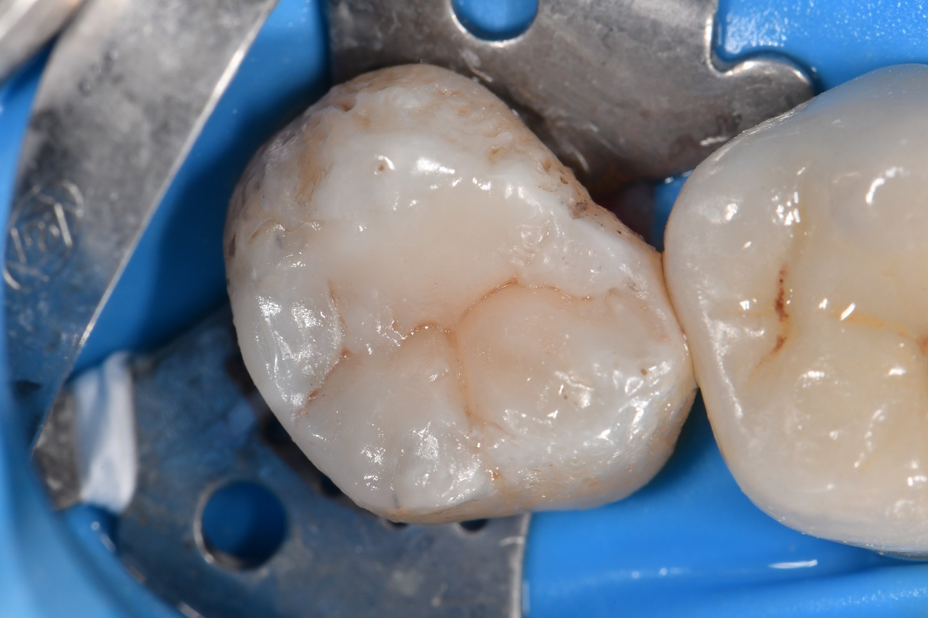 Composite Class II restoration replacement