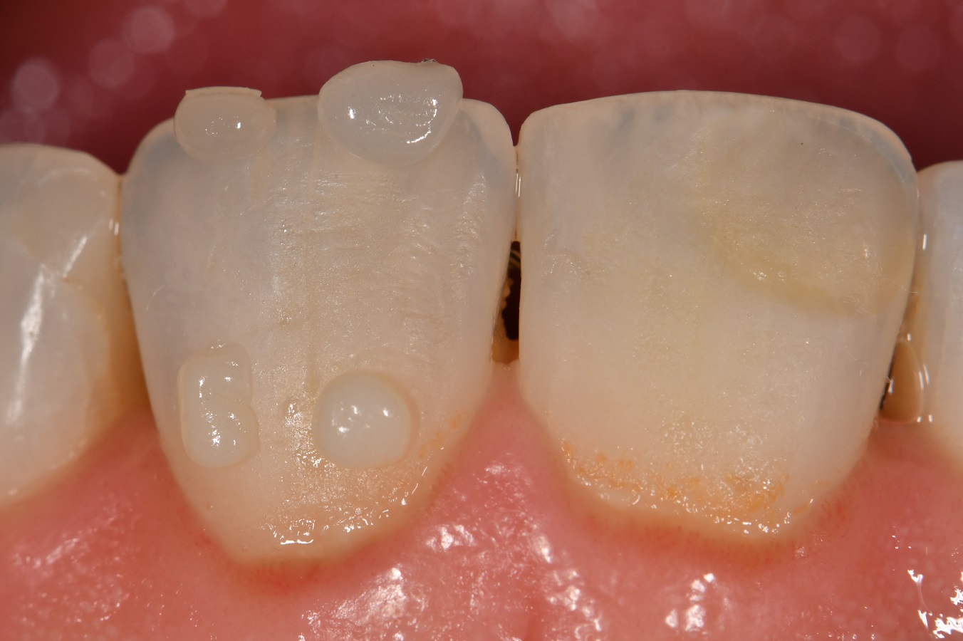 Voco Amaris Composite Veneers