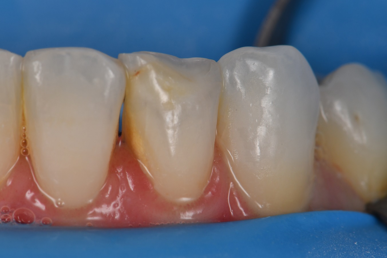 Voco Amaris Composite Veneers