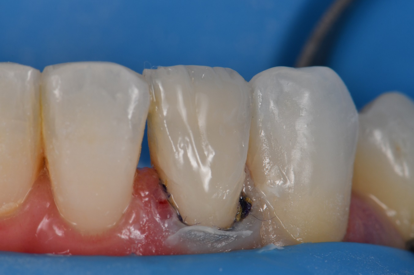 Voco Amaris Composite Veneers