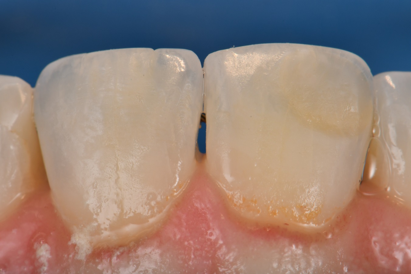Voco Amaris Composite Veneers