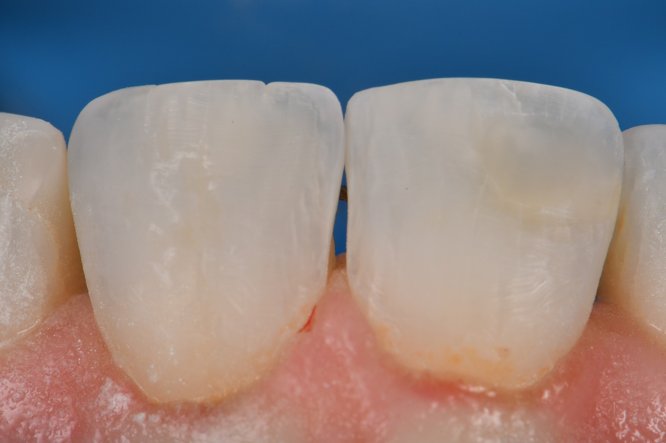 Voco Amaris Composite Veneers