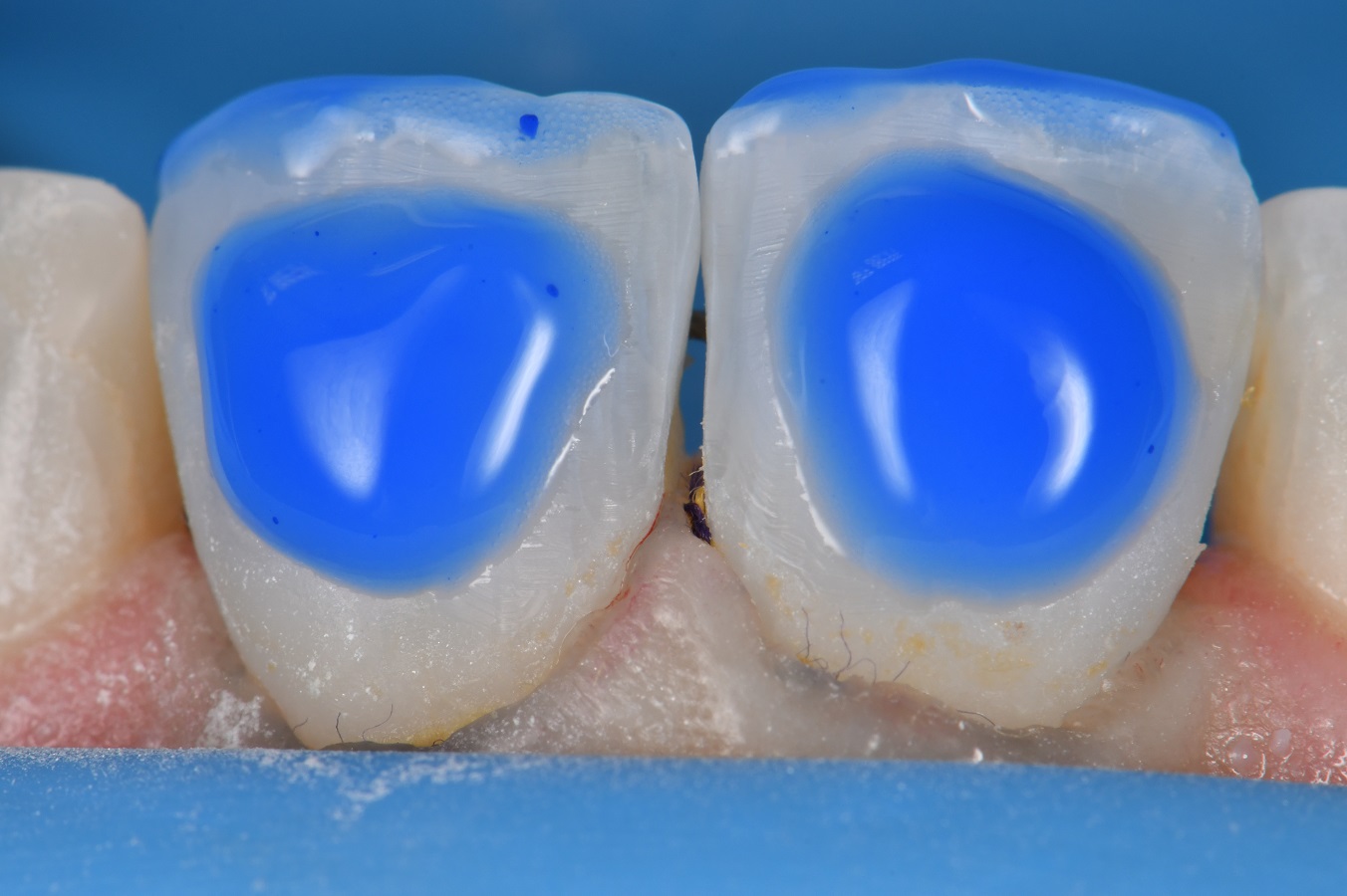 Voco Amaris Composite Veneers