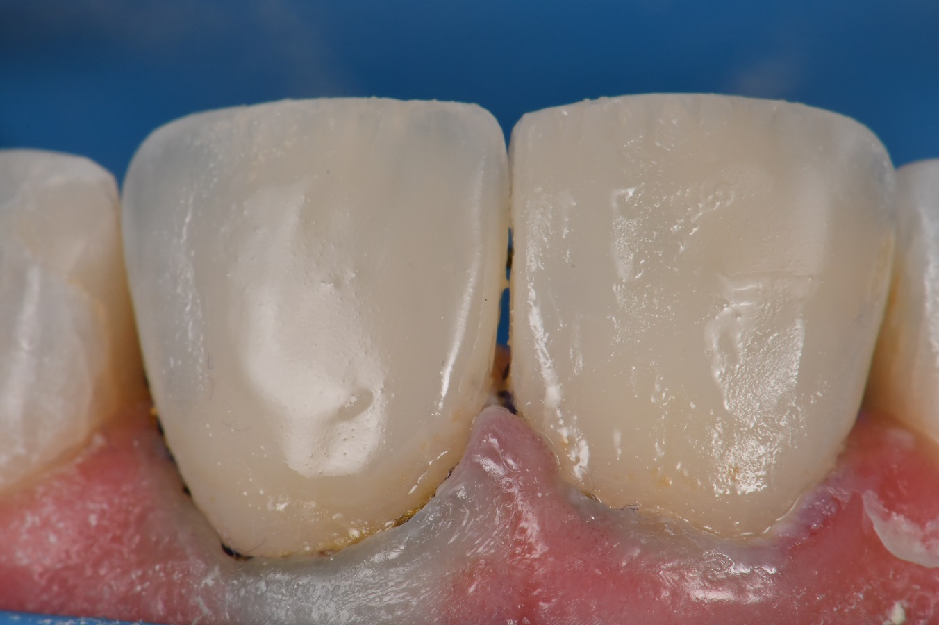 Voco Amaris Composite Veneers