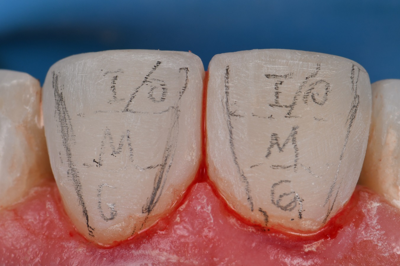 Voco Amaris Composite Veneers