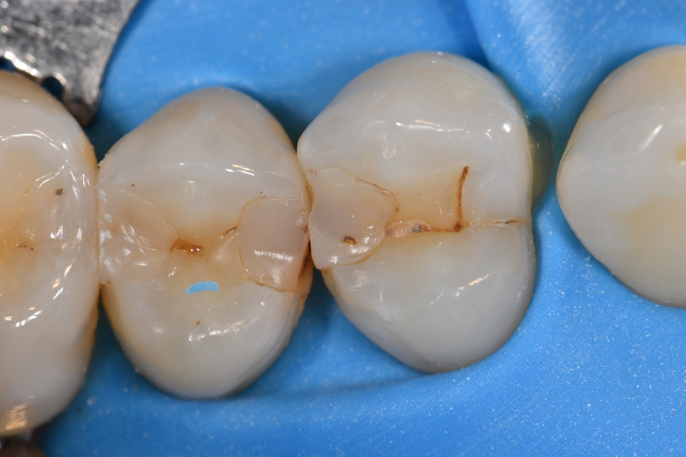 Matrix in a matrix technique in Class II restorations
