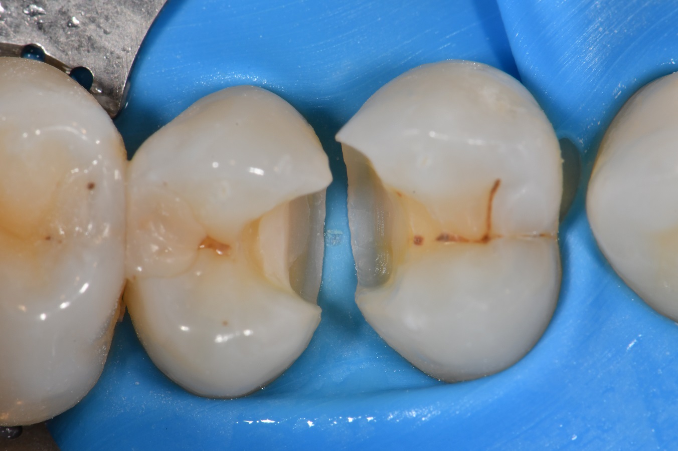 Matrix in a matrix technique in Class II restorations