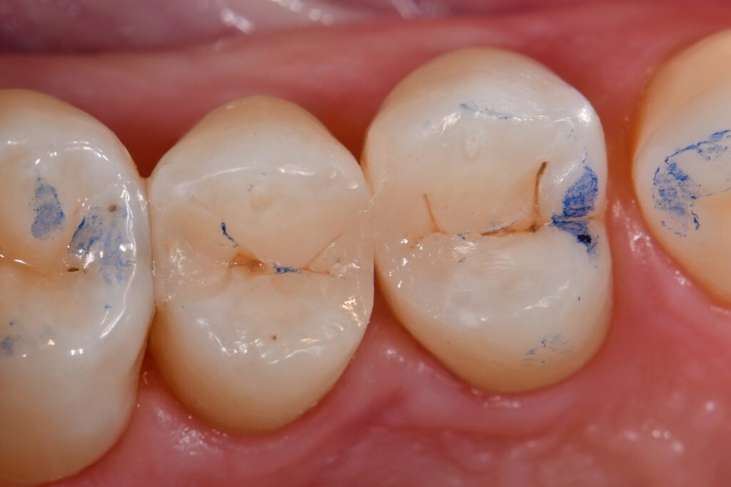 Matrix in a matrix technique in Class II restorations