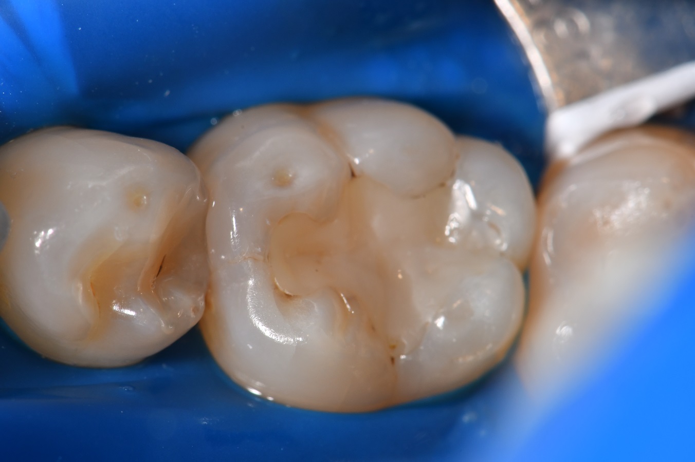 Simplicity and Strength in Posterior Composites with Voco