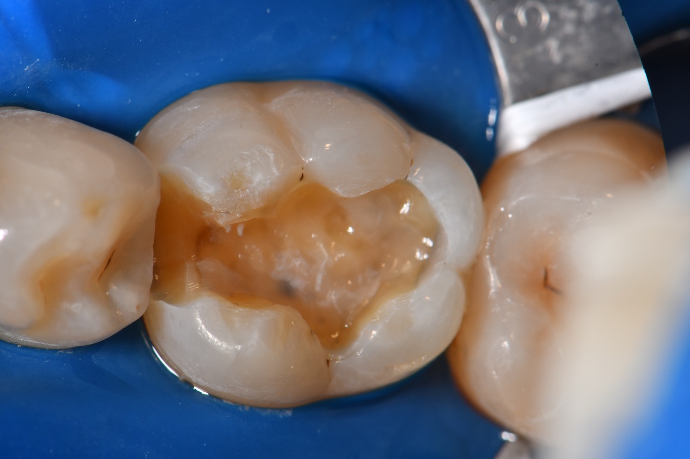 Simplicity and Strength in Posterior Composites with Voco