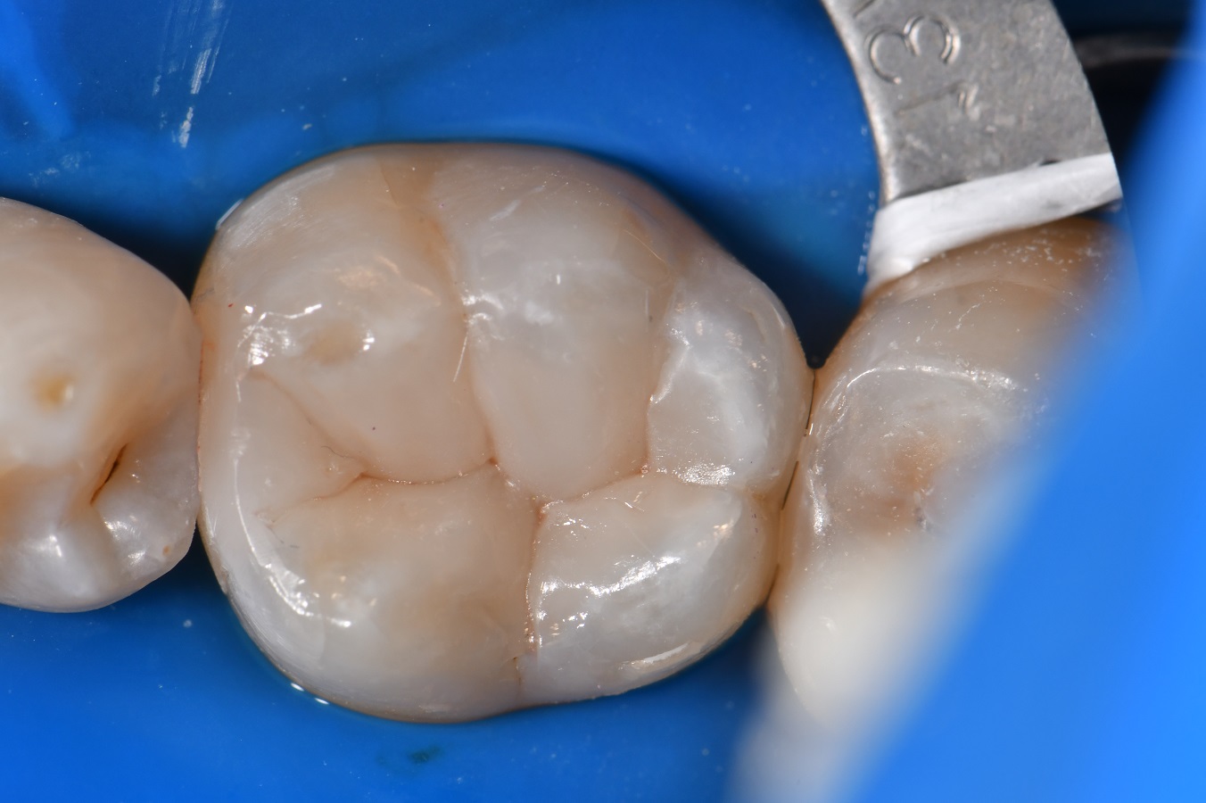 Simplicity and Strength in Posterior Composites with Voco