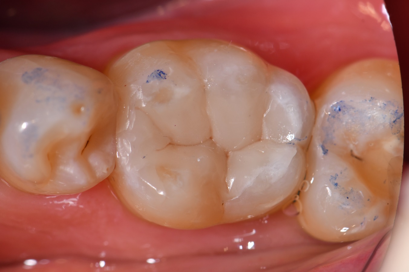 Simplicity and Strength in Posterior Composites with Voco